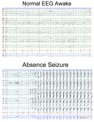 Childhood Absence Epilepsy (CAE) - Petit Mal Epilepsy - Pyknolepsy