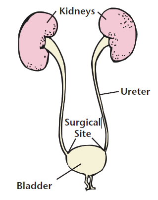 Ureteral Reimplantation Surgery | Children’s Hospital Pittsburgh
